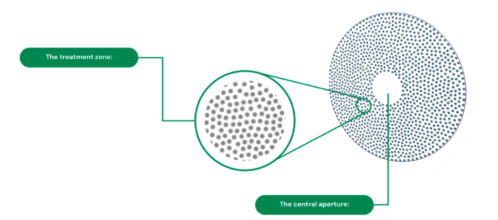 Next-Gen Spectacle Designs for Myopia Management: What We Know Now ...