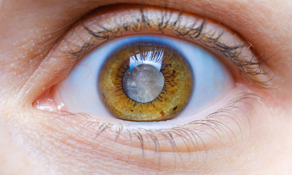 retinal ganglion cells Archives - Review of Myopia Management